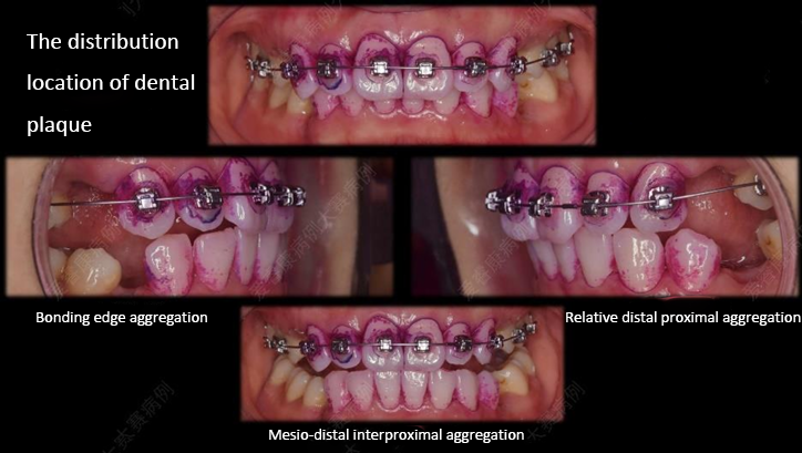 Discover the Revolutionary Plaque Indicator (Dual-Color) and Plaque ...